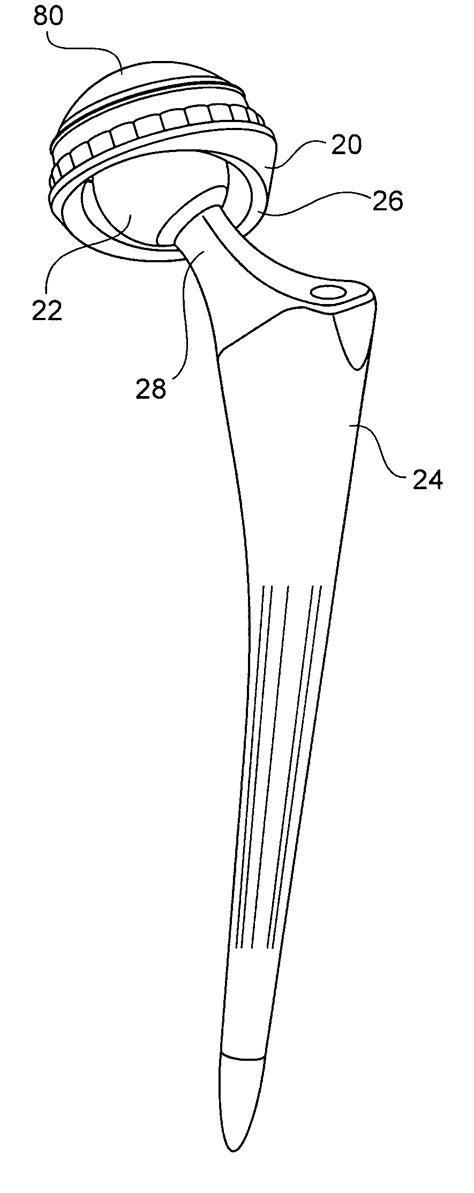 Acetabular Liner Patented Technology Retrieval Search Results Eureka