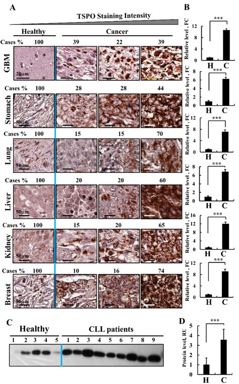 Tspo Over Expression In Cancer A Immunohistochemical Staining Of