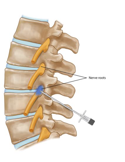 Nerve Root Block Stavya Spine