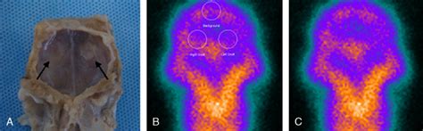 Macroscopic Pathology Of The Right And Left Bone Grafts On The Rabbit Download Scientific