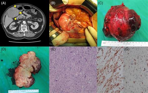 A A Hyperdense Lesion With Irregular Density Yellow Arrow Was Noted Download Scientific