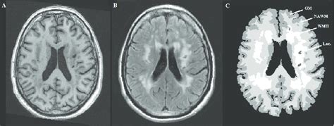 a t1 weighted image b flair image c corresponding tissue