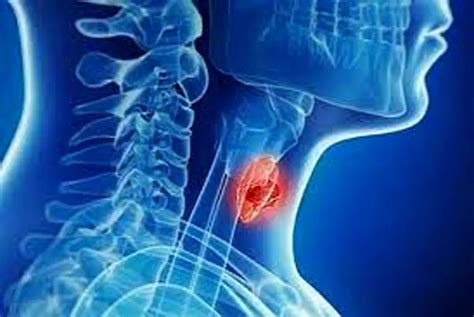 بزرگی تیروئید در ۸۸ درصد دختران در تهران