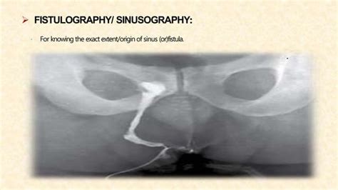 Sinusfistula Ppt 32pptx