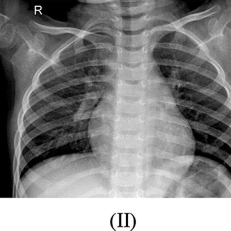 A Sample Of Normal Chest X Ray Images Download Scientific Diagram