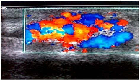 Doppler Ultrasonography An Important Tool In Managing Patients With