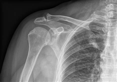Inferior Glenoid Fracture X Ray At Elvira Pierce Blog