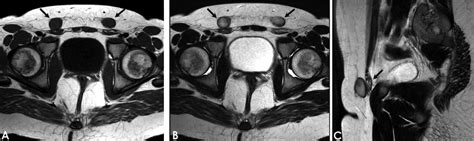 A B Axial T1 And T2 Weighted Images Reveal Bilateral Solid Nodular Download Scientific