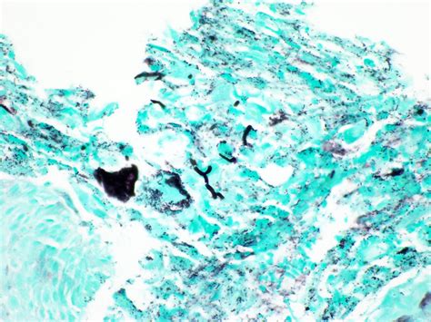 Pathology Outlines Candida Vrogue Co