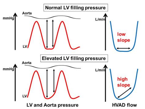 Implication Of Hemodynamic Assessment During Durable Left Ventricular