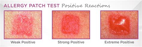 Allergy Patch Testing Phoenix Az Affiliated Dermatology