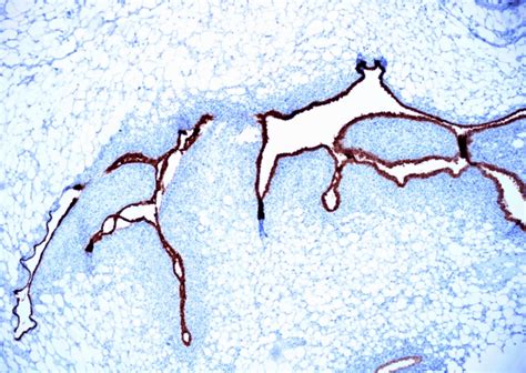 Typical Appearance Of Phyllodes Tumor With Epithelial Component Download Scientific Diagram