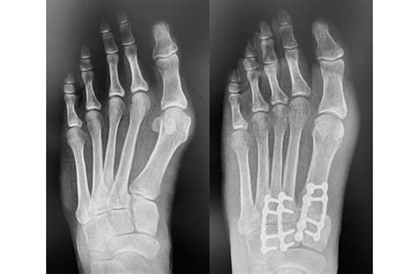 Adductoplasty® Treace