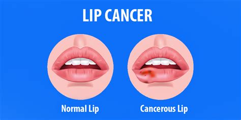 Lip Cancer Causes Symptoms Diagnosis And Treatment Options