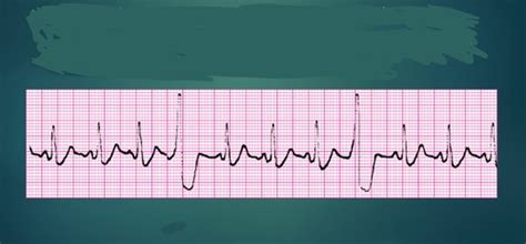 Ventricular Trigeminy