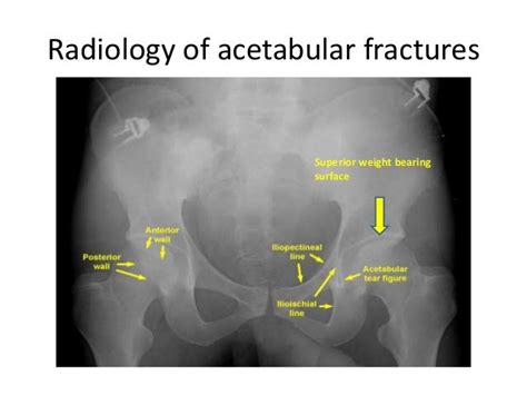 Acetabular Fractures