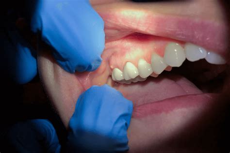 What Is A Tooth Abscess Types Symptoms Causes And Treatments That You Need To Know