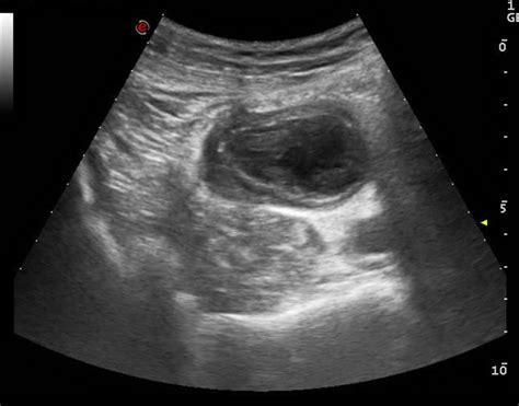 Appendiceal Mucocele Pacs