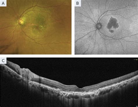 Ga Case Compendium Multimodal Imaging For Following Geographic Atrophy Over Time Modern Optometry