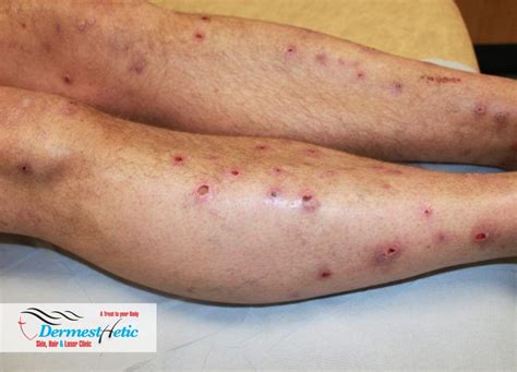 Nodular Prurigo Leaflet