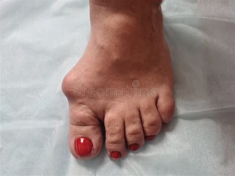 Woman Suffers From Inflammation Of Big Toe Bone Stock Image Image Of