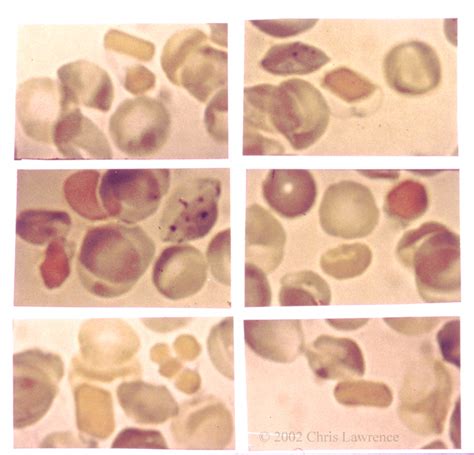 Hemoglobin C Crystals