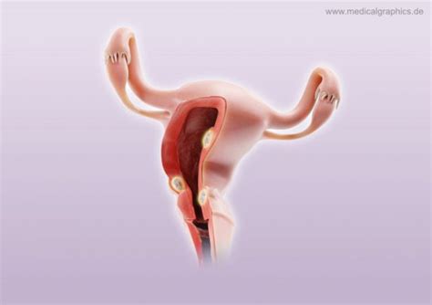 Free Illustration Myoma Uterus Below