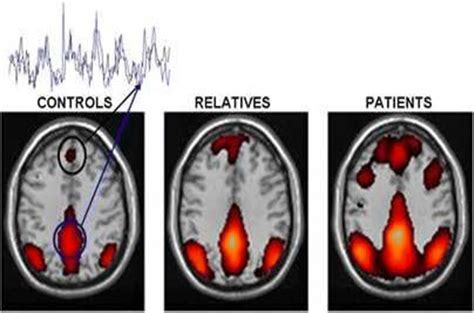 Detection Of Sz Using Fmri Modality Image Src 93 Download