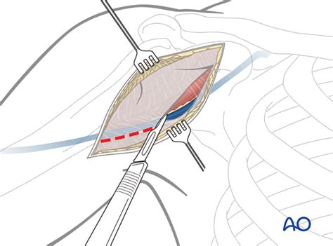 deltopectoral interval approach to the proximal humerus
