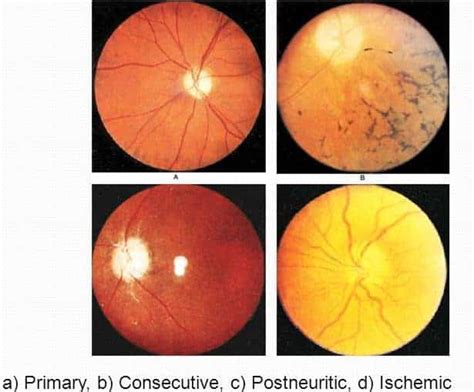Optic Atrophy New