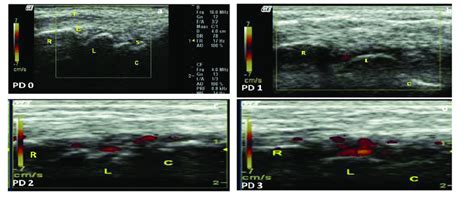 Synovitis Identified By Power Doppler Pd Ultrasound In A Dorsal Download Scientific Diagram