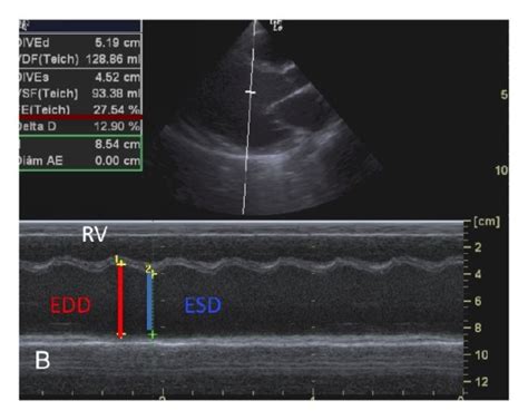 Stroke Volume Sv Calculation A Measurement Of Lv Outflow Tract Download Scientific Diagram