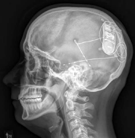 Connie May Mhst On Linkedin Start Up Wearable Stimulates Brainwaves