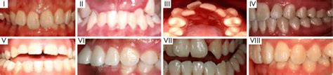 The Indications Of Different Types Of Malocclusion Deformity I Deep