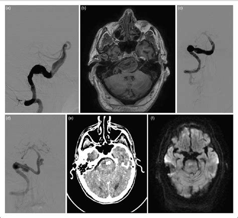 Figure 1 From Treatment Of Vertebrobasilar Fusiform Aneurysms With Pipeline Embolization Device