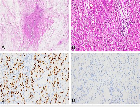Histological Evaluation Of The Surgical Specimen After Nac A No