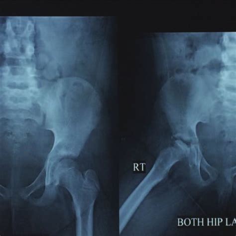 Both Hip Joints In Standing And Diversion Positions Note The Right Hip
