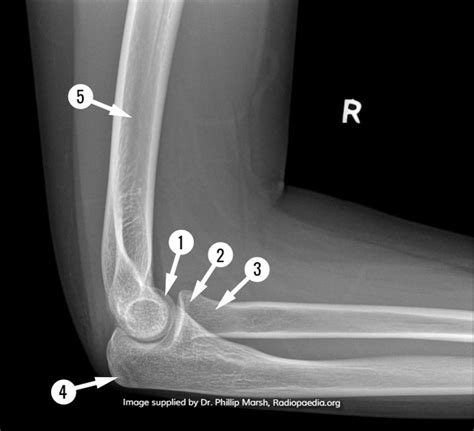 Elbow Xray Anatomy Radiopaedia