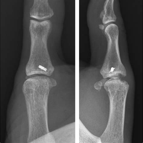 Thumb Mcp Joint Fusion Thomas R Hunt Iii Md Dsc