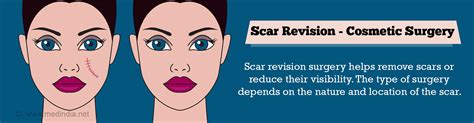 Scar Revision Cosmetic Surgery
