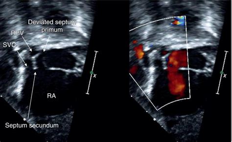 21 Hypoplastic Left Heart Syndrome Veterian Key