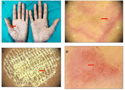 Clinical And Dermoscopic Study Of Palmoplantar Keratodermas Clinical And Dermoscopic Study Of Palmoplantar Keratodermas