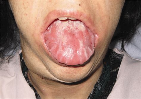 Macroglossia Amyloidosis