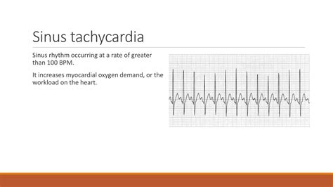Abnormal Ecg Arhythmiapptx