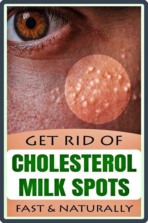 Faqs About High Cholesterol Treatment Artofit