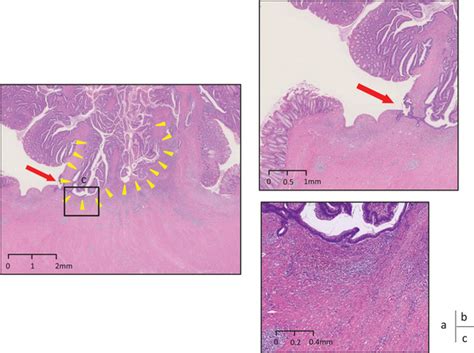 Surgical Resection Identified Pseudo‐invasion With Submucosal Dense