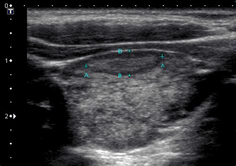 Ultrasound Thyroiditis Imaging “thyroiditis” A Primer For