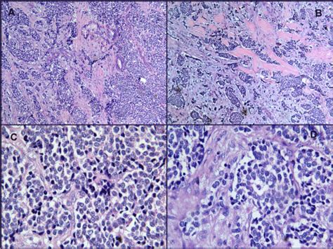 A Rare Case Of Peripheral Primitive Neuroectodermal Tumor In Palate