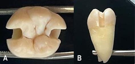 Standardized Class Ii Cavity Preparation A Occlusal View B Aproximal Download Scientific