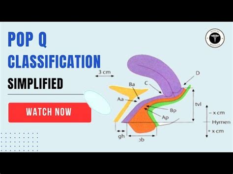 Pop Q Classification Simplified Pelvic Organ Prolapse Staging